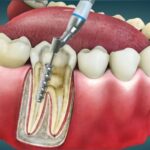 Root Canals: What to Expect Before, During, and After