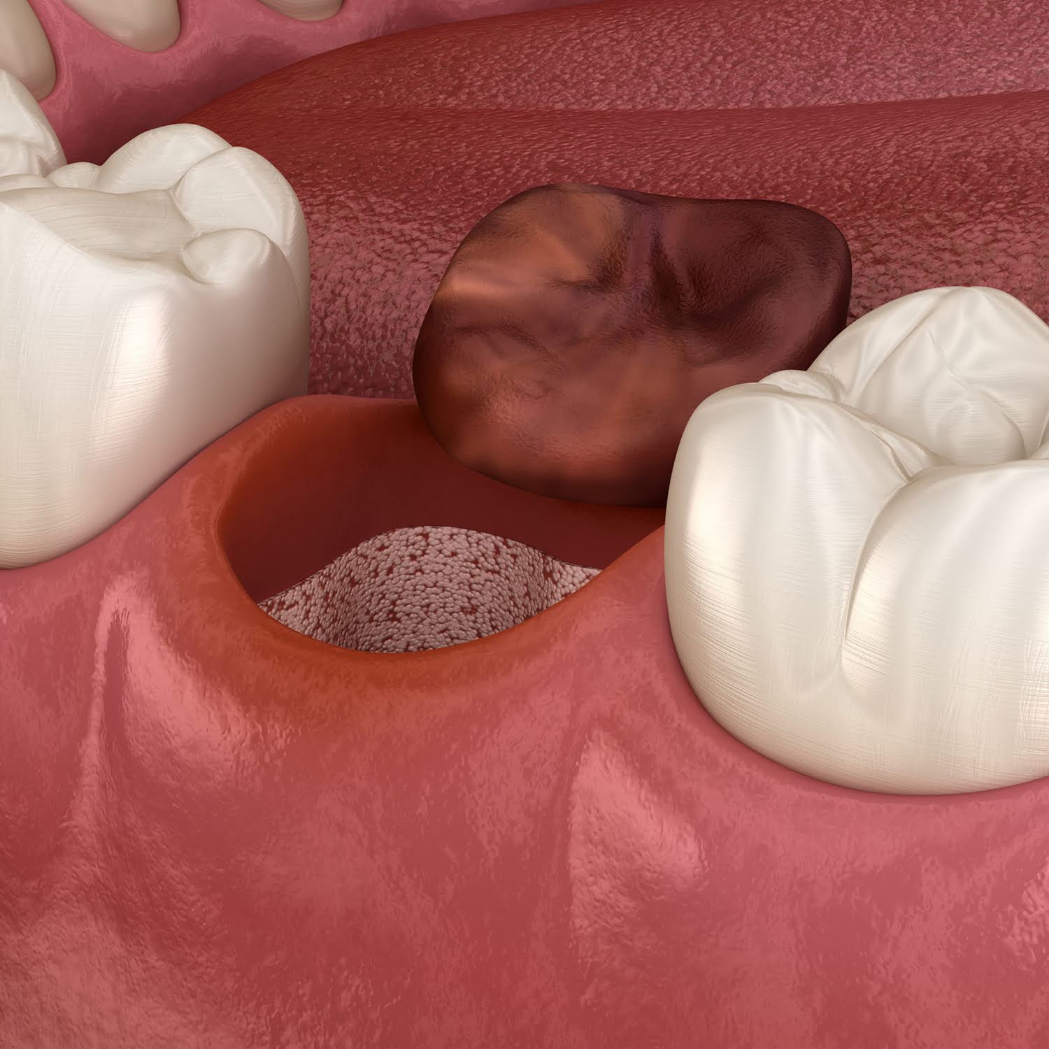 Care for Your Mouth After Tooth Removal: A Complete Guide